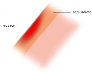 Brûlure : thermiques, chimiques, par le soleil, par le froid...