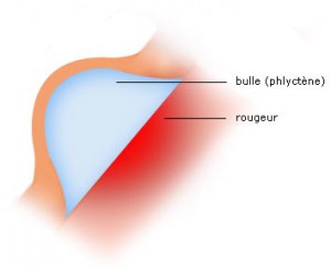 Brûlure : thermiques, chimiques, par le soleil, par le froid...