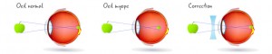 Myopie : Définition et traitement - Santé sur le Net