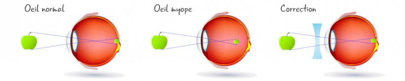 Myopie : Définition et traitement - Santé sur le Net