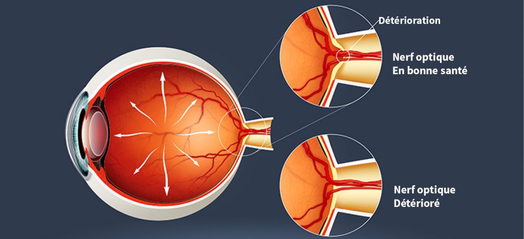 3 innovations dans le traitement du glaucome - Santé sur le Net