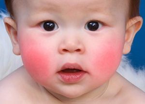 Érythème infectieux / Mégalérythème / Cinquième maladie