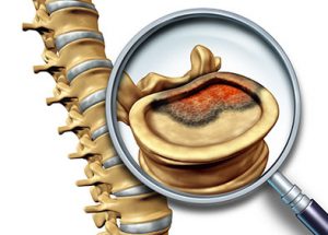 Cancer des os de l'enfant : définition, traitements - Santé sur le Net
