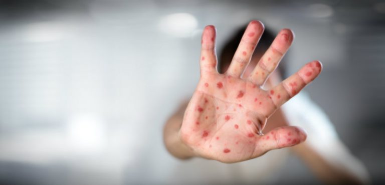 Rougeole : symptômes, complications, traitement, prévention...
