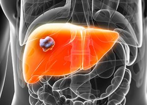 Cancer du foie : Facteurs de risque - Symptômes - Diagnostic- Traitements