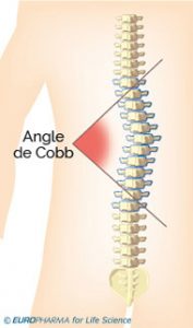 Scoliose : Définition, symptômes, diagnostic et traitements.