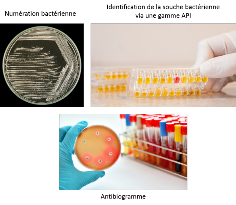 Pyélonéphrite aigüe : définition, symptômes, traitements