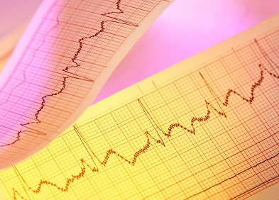 Fibrillation atriale ou auriculaire : causes, symptômes, traitements