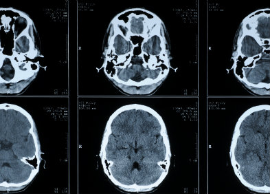 Scintigraphie : indications, consignes - Santé sur le Net