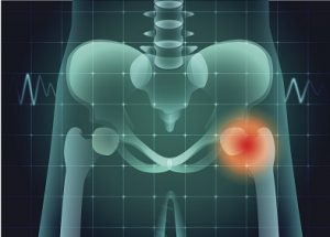 Arthrose de la hanche : définition, symptômes, traitement