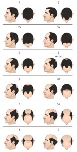 Calvitie - Définition et symptômes - Santé sur le net