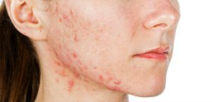 Le trifarotène, l’arsenal thérapeutique contre l’acné