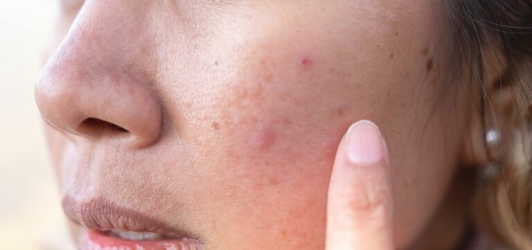 ALLERGIE : causes, symptômes, traitements de chaque type d'allergie.