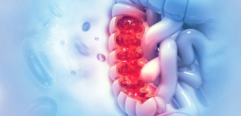Cancer de l’intestin grêle : définition et symptômes - Santé sur le net
