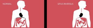 Situs inversus : définition et prise en charge - Santé sur le net