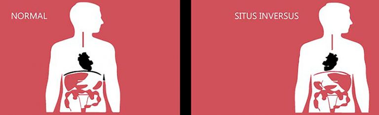 Situs inversus : définition et prise en charge - Santé sur le net