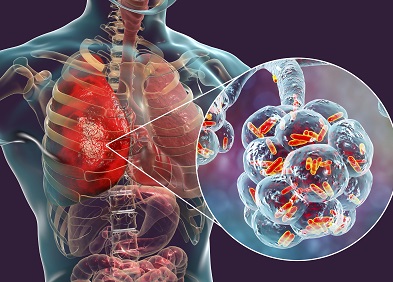 Pneumologie - Tout savoir sur les maladies des voies respiratoires