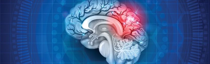 Gliome infiltrant du tronc cérébral : définition - Santé sur le Net