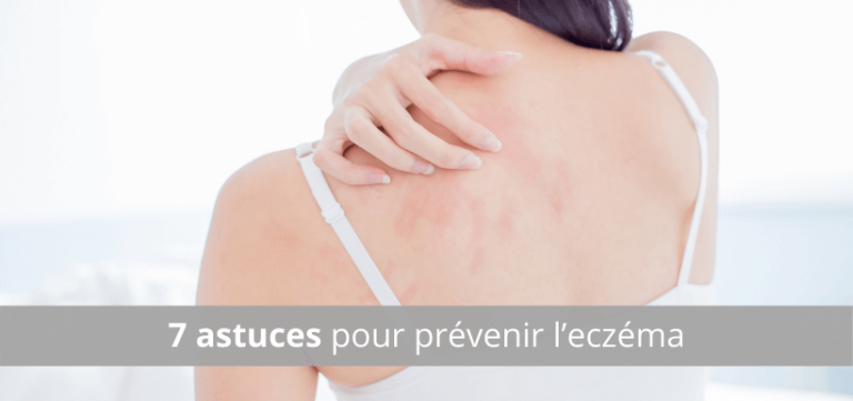 7 astuces simples pour prévenir efficacement l’eczéma
