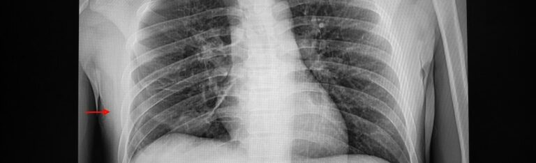 Pneumothorax : Définitions, symptômes, diagnostic et traitements
