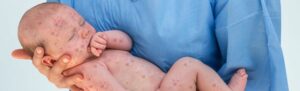 Rubéole : Définition, symptômes, diagnostic et traitements