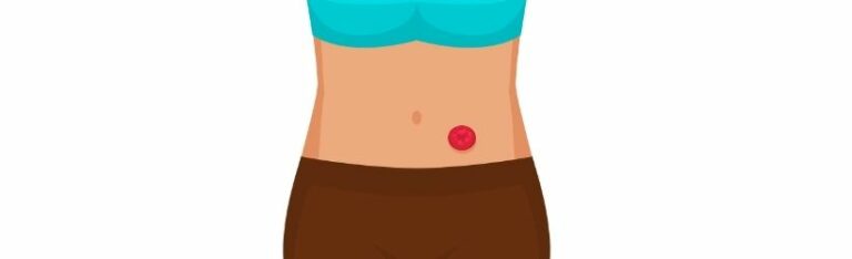 Stomie : Définition, symptômes, diagnostic et traitements