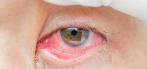 Yeux rouges, principal signe de la conjonctivite