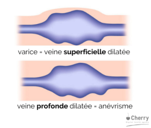Varice : Définitions Formation Évolution Symptômes Diagnostic...