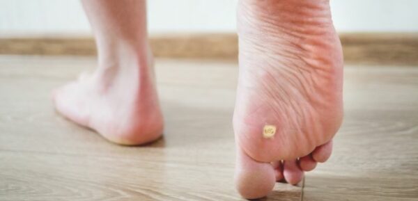 Verrues : définition, diagnostic et traitement