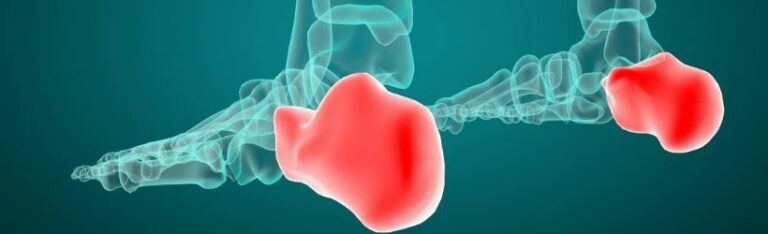 Maladie de Sever : Définition, symptômes, diagnostic et traitements