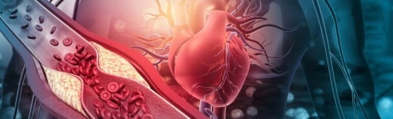 Infarctus du myocarde : causes, symptômes, traitements