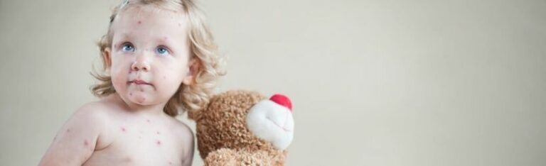 Rougeole : symptômes, complications, traitement, prévention...