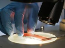 Macrocytose : Définition, symptômes, diagnostic et traitements