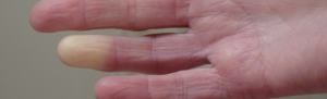 Maladie de Raynaud : définition, symptômes & traitement