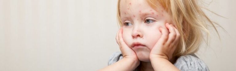 Varicelle : transmission, incubation, aspect clinique...