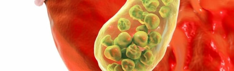 Angiocholite : Définition, symptômes, diagnostic et traitements