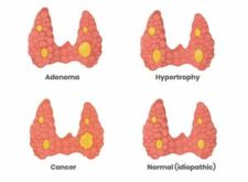 Hyperparathyroïdie : Définition, symptômes, diagnostic, traitements