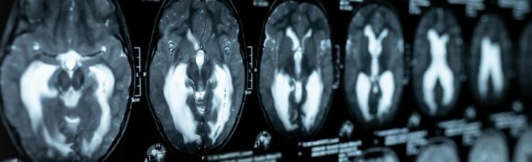 Hydrocéphalie : Définition, symptômes, diagnostic et traitements