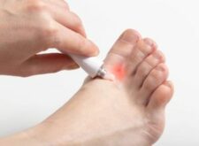 Intertrigo : Définition, symptômes, diagnostic et traitements