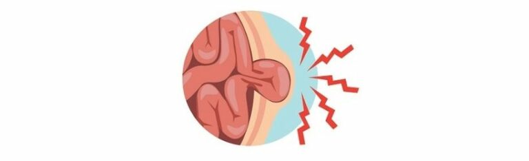Hernie inguinale : définition, symptômes et traitement