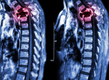 Chondrosarcome : définition, symptômes, diagnostic et traitements