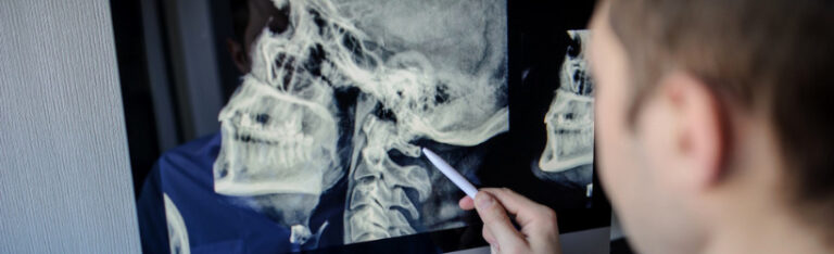 Chondrosarcome : définition, symptômes, diagnostic et traitements