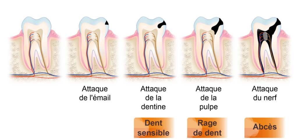 Necrose Nerf Dent | Nécrose Dentaire Traitement – YINSBK