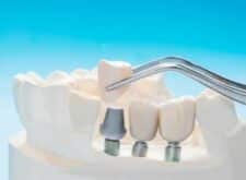 Dent sur pivot et implant dentaire : différences et caractéristiques