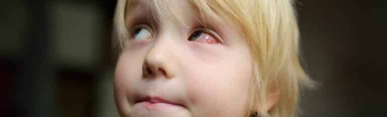 Conjonctivite : Causes, symptômes et traitements