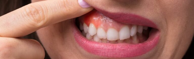 Fistule dentaire : Définition, symptômes, diagnostic et traitements