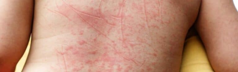 Roséole infantile ou exanthème subit ou la sixième maladie