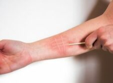 Dermographisme : Définition, symptômes, diagnostic et traitements