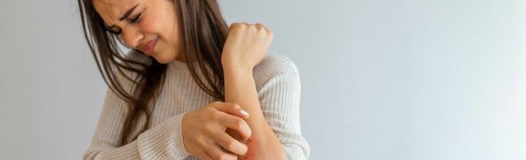 Dermographisme : Définition, symptômes, diagnostic et traitements