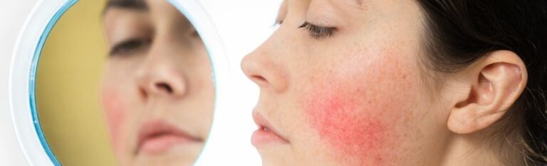 Couperose : Définition, symptômes, diagnostic et traitements